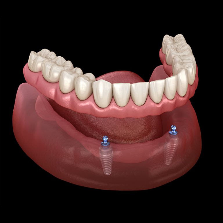 Removable Dentures on Implants in Penticton